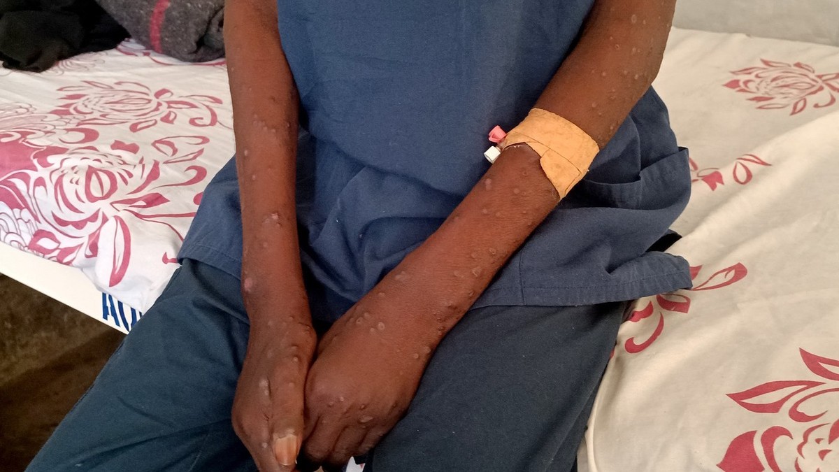 Krajinami Európy sa šíria opičie kiahne | TVNOVINY.sk